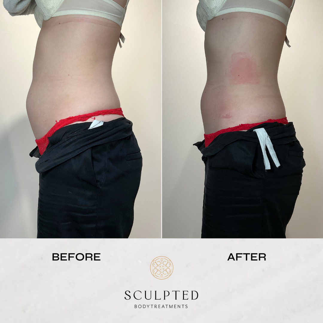Sculpted - Body treatments - Sculpted