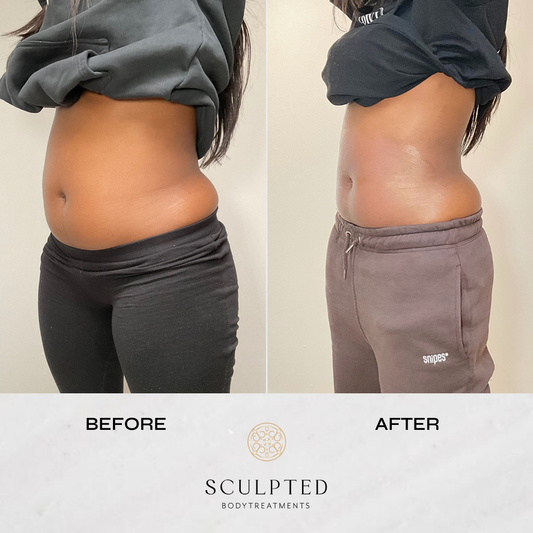 Sculpted - Body treatments - Sculpted